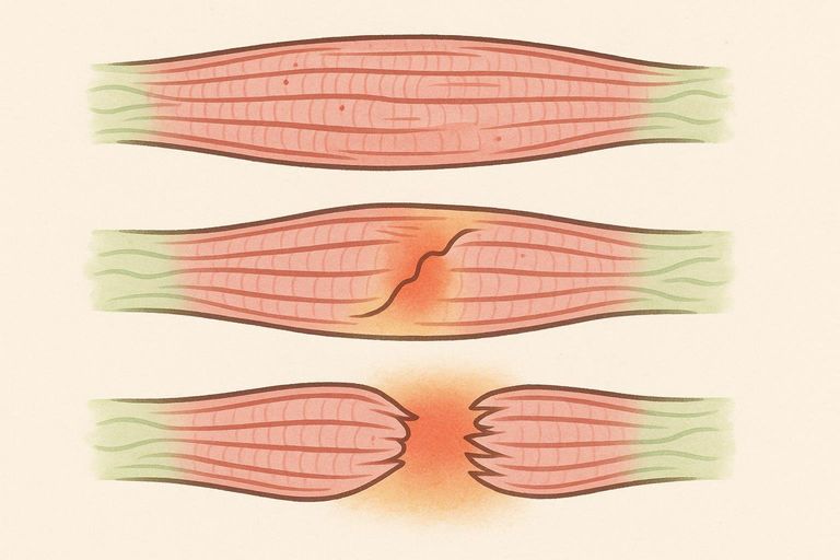 Pulled Chest Muscle Symptoms and Strain Diagnosis | BodySpec